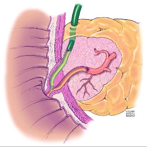 Pdf Precut Sphincterotomy For Selective Biliary Duct Cannulation
