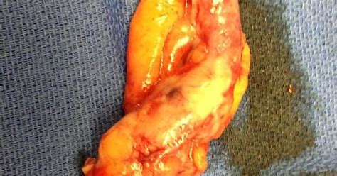 This Was My Appendix There Are Many Like It But This One Was Mine Imgur