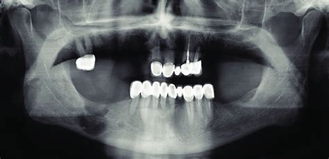 Radiolucent Lesion With A Soap Bubble Appearance In The Right