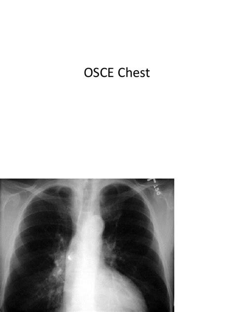 Osce Chest Pdf Thorax Lung