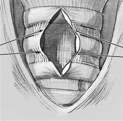 Tracheal Incision After Dilatation With Stay Sutures In Place From