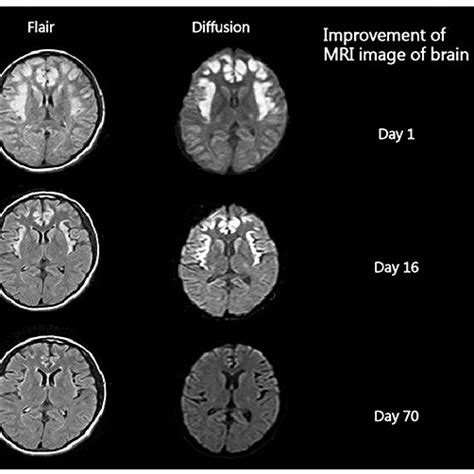 Brain Mri According To The Patients Disease Days The High Signal Area Download Scientific