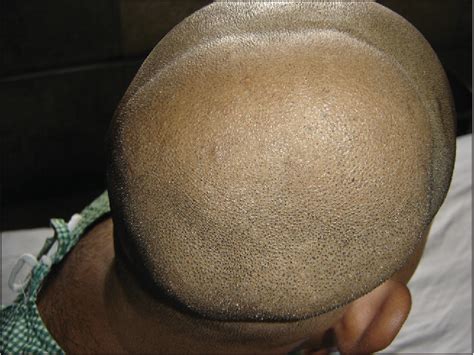 Figure 1 From Diffuse Neurofibroma Of Scalp Semantic Scholar