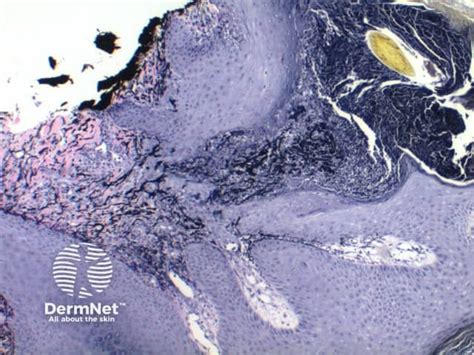 Elastosis Perforans Serpiginosa Pathology