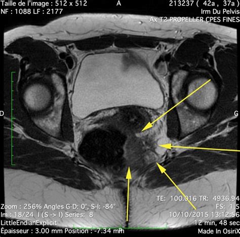Double Disc Excision For Large Low Rectal Endometriosis Dissection Of Parametrium And Sacral