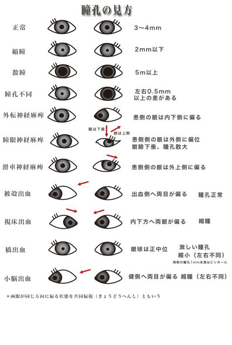 瞳孔縮小的原因有哪些 瞳孔 散大 瞳孔異常：症狀、病因及如何治療 Swzz