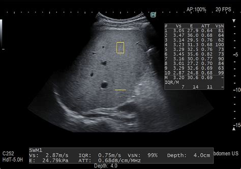 Quantification Of Liver Fat Content With Ultrasound A Wfumb Position
