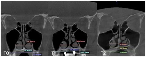 Applications Of The Novel Midpalatal Piezocorticotomy Guide For Marpe