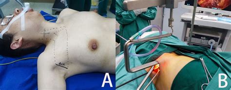 Frontiers “elastic Stretch Cavity Building” System In Endoscopic