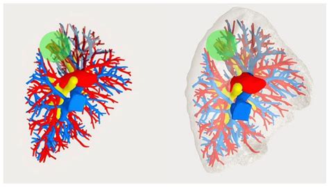 Three Dimensional Imaging Guided Lung Anatomic Segmentectomy A Single Center Preliminary Experiment