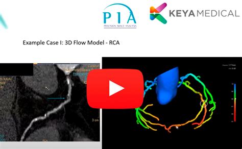 Scaling Your Cardiovascular Ct Service And Implementing Ct Ffr