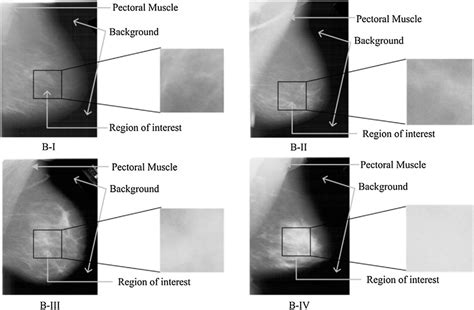 Sample Of Extracted Roi For Each Birads Breast Density Class Download Scientific Diagram