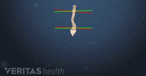 Scoliotic Curve Definition Back Pain And Neck Pain Medical Glossary