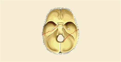 Longitudinal Temporal Bone Fracture Vs Transverse Temporal Bone Fractu Knya