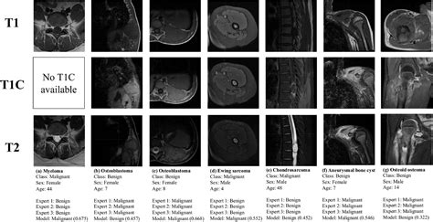 Osseous Lesions