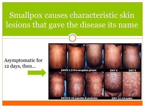 Ppt Smallpox Powerpoint Presentation Free Download Id3061148