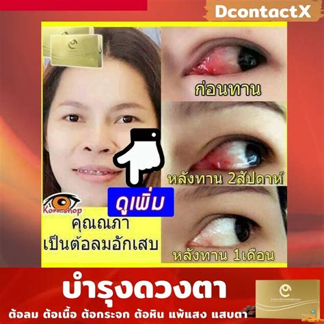 ปัญหาดวงตา เป็นได้ก็หายได้ ต้อกระจก ต้อลม ต้อเนื้อ ต้อหิน สายตาสั้น สายตายาว ตามัว มอง