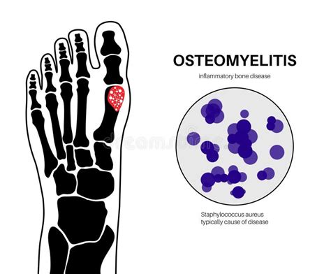 Osteomyelitis Disease Poster Stock Vector Illustration Of Treatment