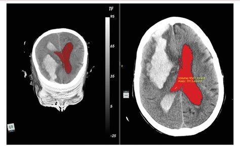 Figure 4 From Brain Morphometry In Adult Volumetric Visualization As A