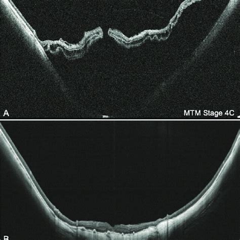 Severe Myopic Traction Maculopathy Stage 4c With Macular Retinal
