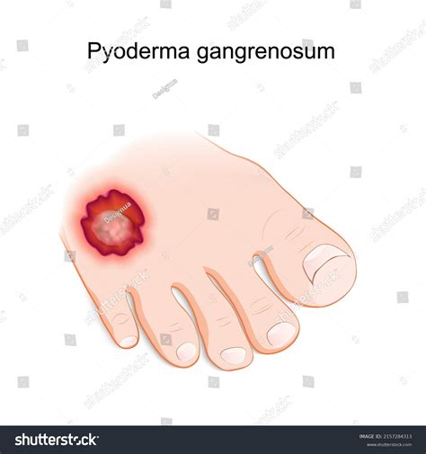 Pyoderma Gangrenosum Over 23 Royalty Free Licensable Stock