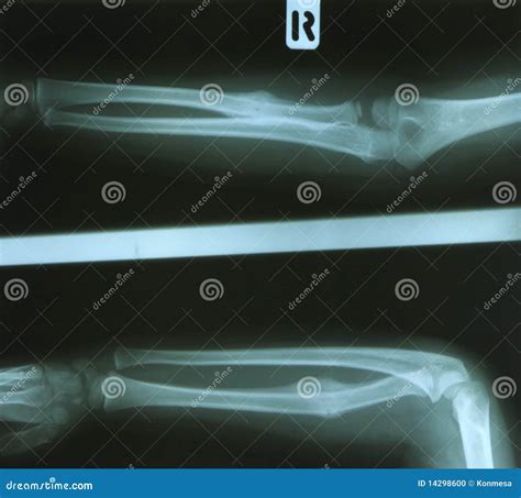 Radius Fracture Stock Photo Image Of Broken Care Fracture