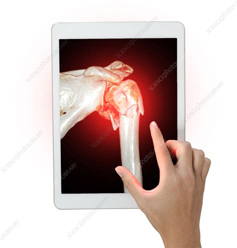 Humerus Bone Fracture Conceptual Image Stock Image F0433180 Science Photo Library