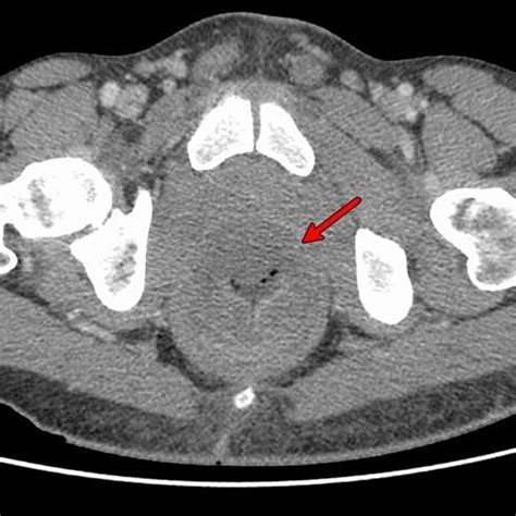 Left Vesiculopustular Lesions With Some Overlying Ulcerations