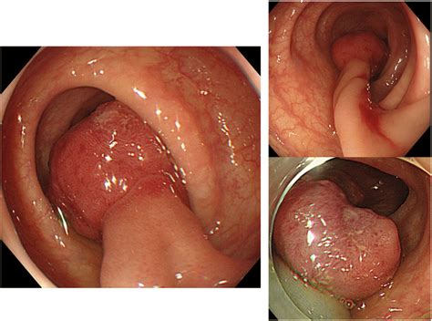 Colonoscopic Findings A 20 Mm Pedunculated Polyp Is Present In The Download Scientific Diagram
