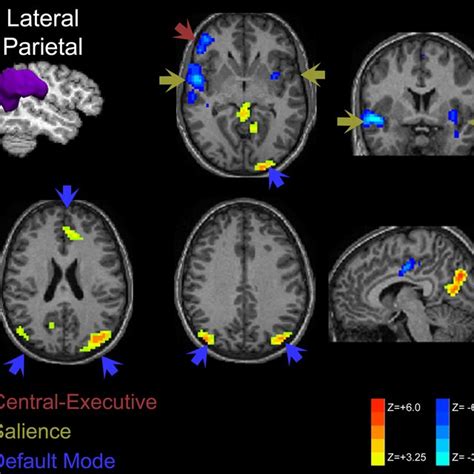 Posteromedial Cortex Connectivity Comparison Of Late Preterms Versus