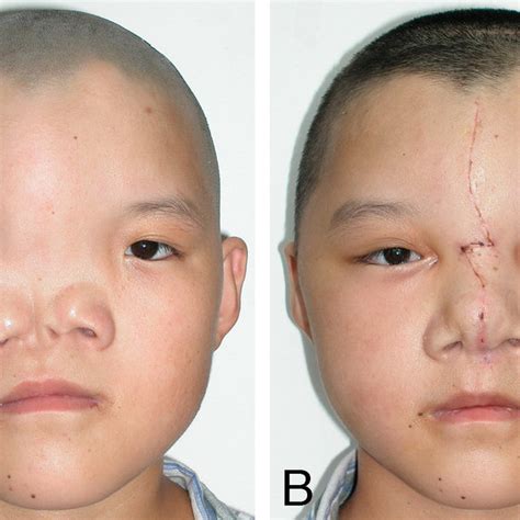 A 2 Year Old Girl With Severe Facial Cleft A Preoperative Frontal
