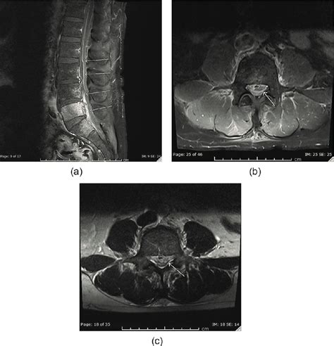 A Sagittal T1 Post Contrast And B Axial T1 Post Contrast Shows