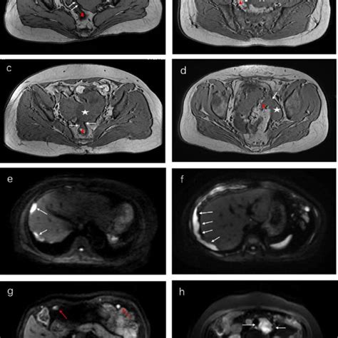 Image Features Of The Mri Variables A D Four Grades Of Relationship Download Scientific