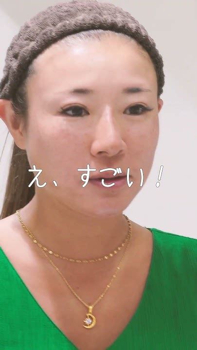 【整形しないコンプレックス治療】40歳女性｜ヒアルロン酸ビフォーアフター Shorts ヒアルロン酸 ビフォーアフター Youtube