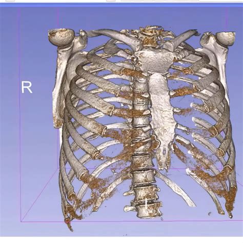 3d Printable Convert Your Ct Mri Scans To 3d Printable File By Asem