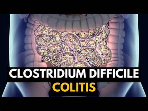 Cause Of C Diff Infection