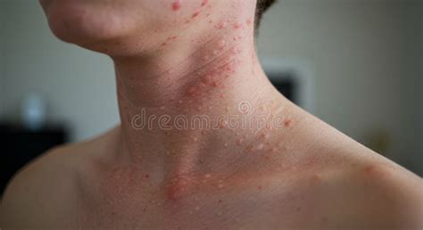 Itchy Rash On Neck And Chest Rash On Hands Causes And When To Speak