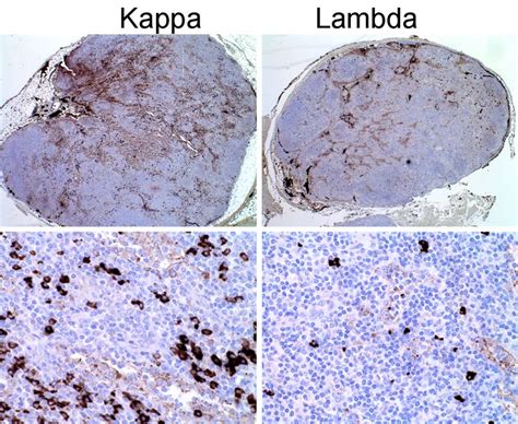 Pathology Outlines Lymphoma