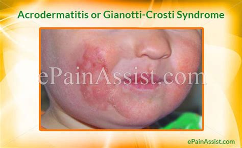 Acrodermatitis Or Gianotti Crosti Syndrome Causes Signs Symptoms