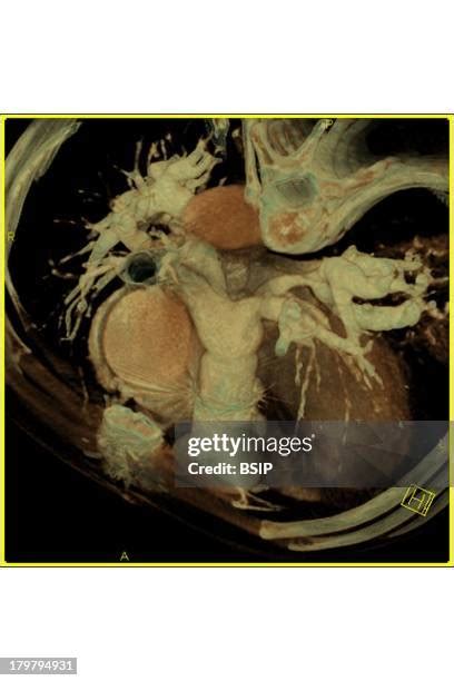 Vascular Prosthesis Photos And Premium High Res Pictures Getty Images