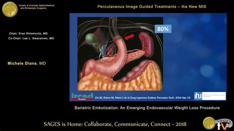 Bariatric Embolization An Emerging Endovascular Weight Loss Procedure Youtube