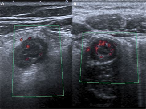 A Increased Doppler Signal In A Thickened Oedematous Appendix In An Download Scientific