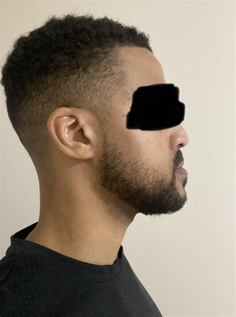 Would You Recommend Ujs Or Djs For Underbite R Jawsurgery