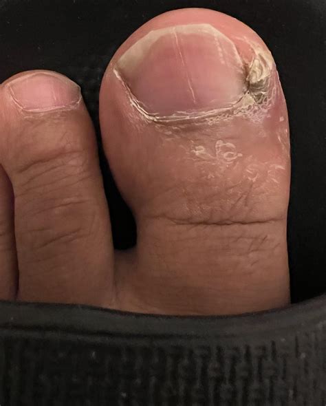 Granulation Tissue R Ingrown Toenails