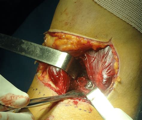 Demonstration Of Fixation Of The Avulsed Fragment By Screw Download Scientific Diagram
