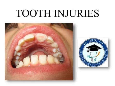 Tooth Injuries Tooth Trauma Treatment Of Tooth Trauma Pptx