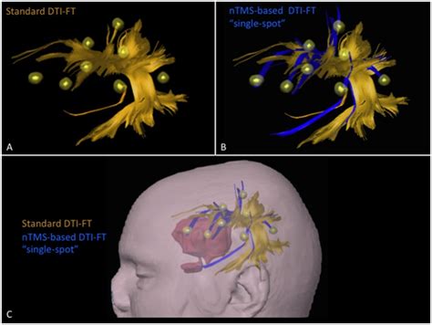 A Novel Technique For Region And Linguistic Specific Ntms Based Dti Fiber Tracking Of Language
