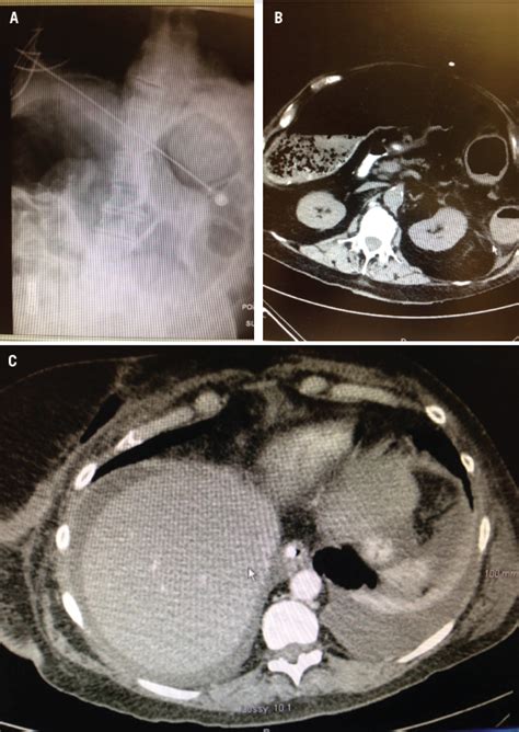 Clostridium Difficile Infection What You Need To Know Consultant360