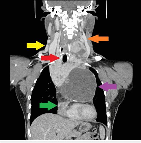 Ct Coronal Plane Of The Thyroid Gland With Extension Into The