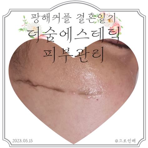 중랑구피부관리 더숨에스테틱 스킨 플래닝 후기 네이버 블로그
